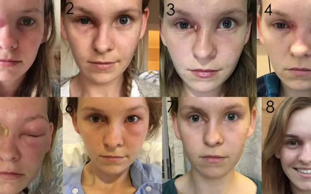 13 Symptoms Of A Sinus Infection And When To See A Doctor? - PostureInfoHub